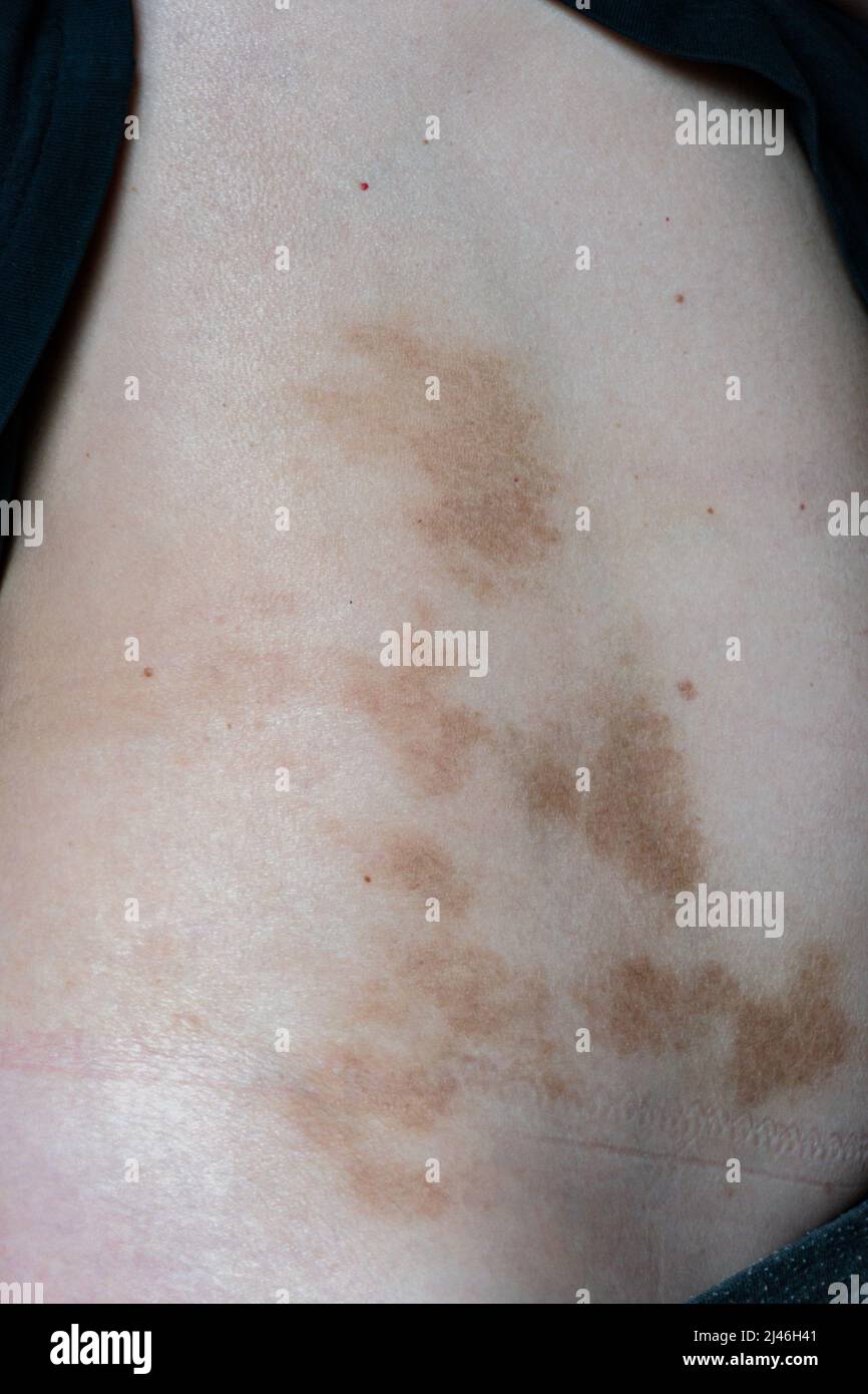 Taches brunes peau humaine Banque de photographies et d’images à haute ...