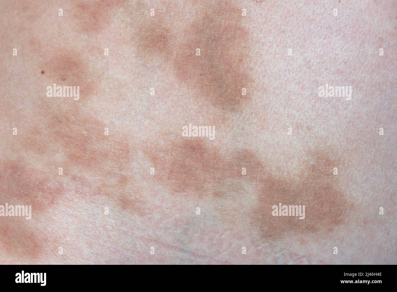Taches brunes peau humaine Banque de photographies et d’images à haute ...