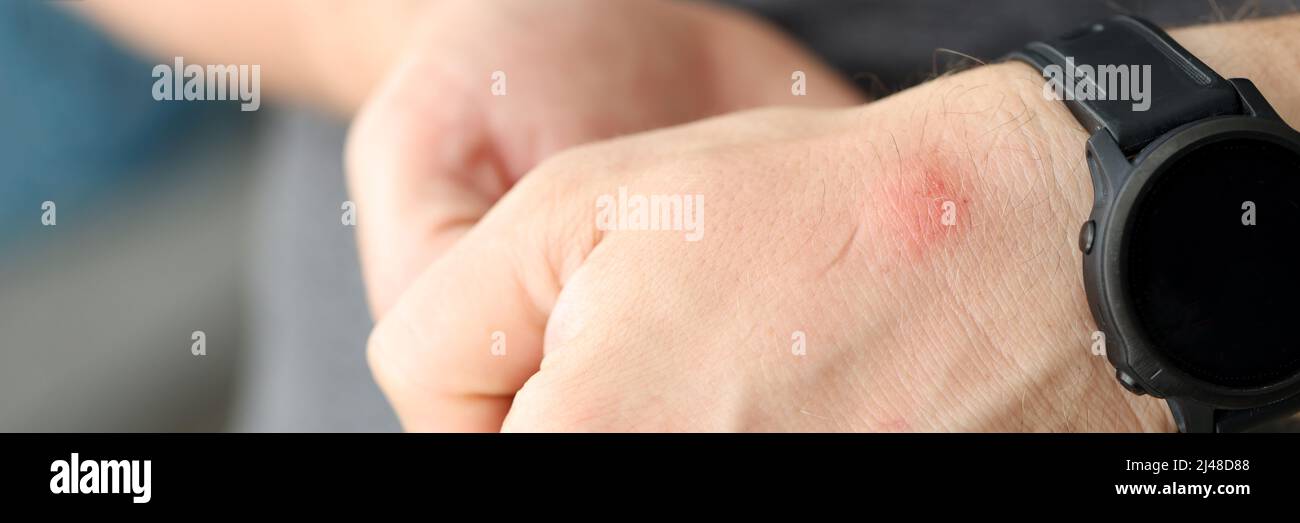 Tache rouge peau Banque de photographies et d’images à haute résolution ...