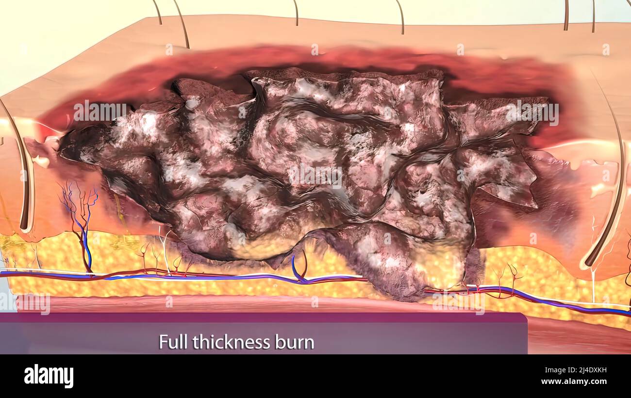 Brûlures Au Troisième Degré Banque d'image et photos - Alamy