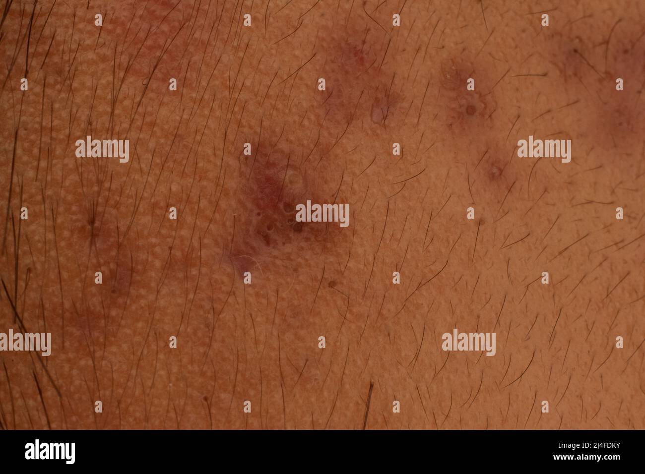 Assombrir les cicatrices d'acné sur la joue Photo Stock - Alamy