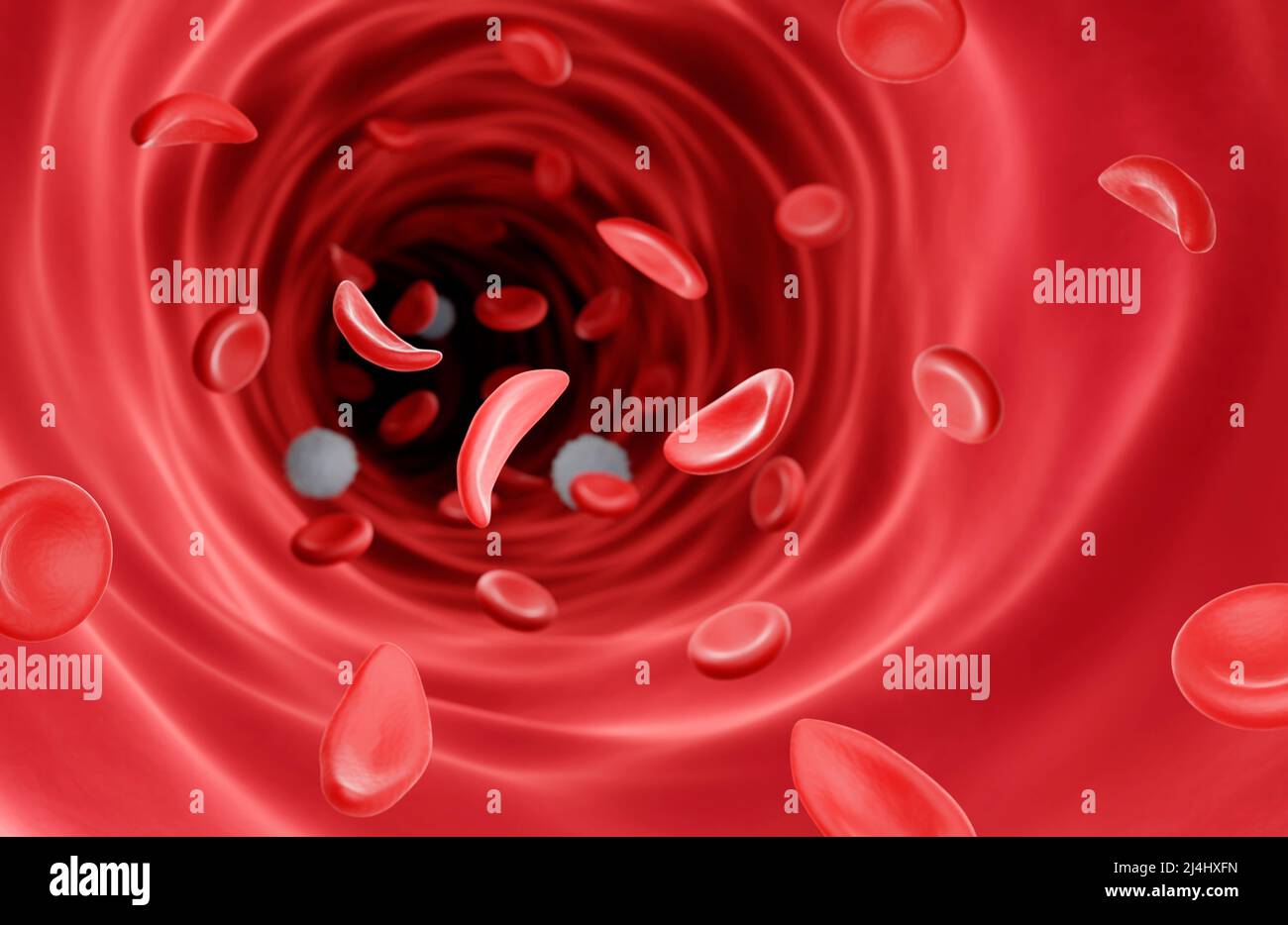 Sickle cell disease Banque de photographies et d’images à haute ...