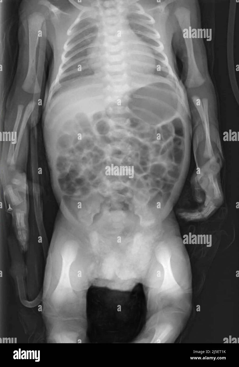 Baby x ray Banque de photographies et d’images à haute résolution - Alamy
