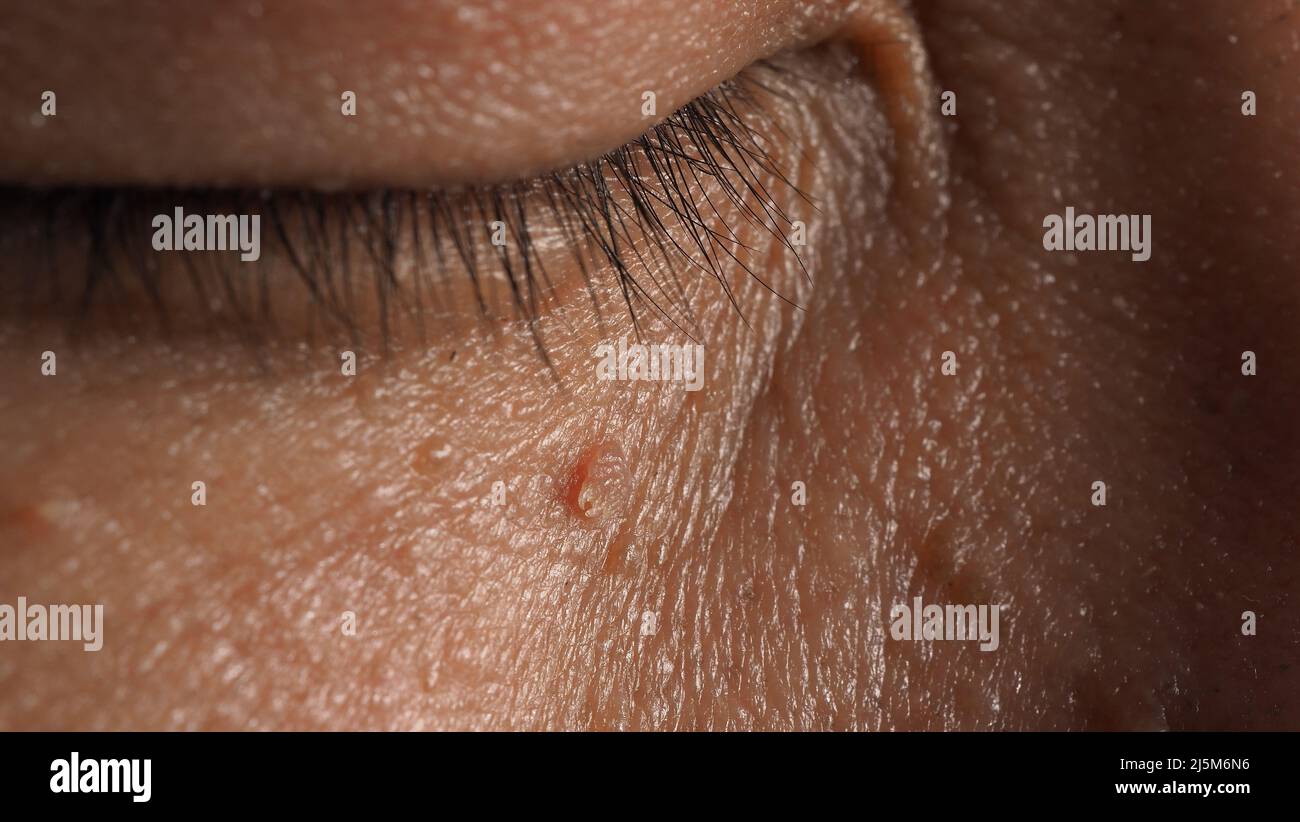 Élimination de la déformation cutanée. Photo macro des verrues près de ...