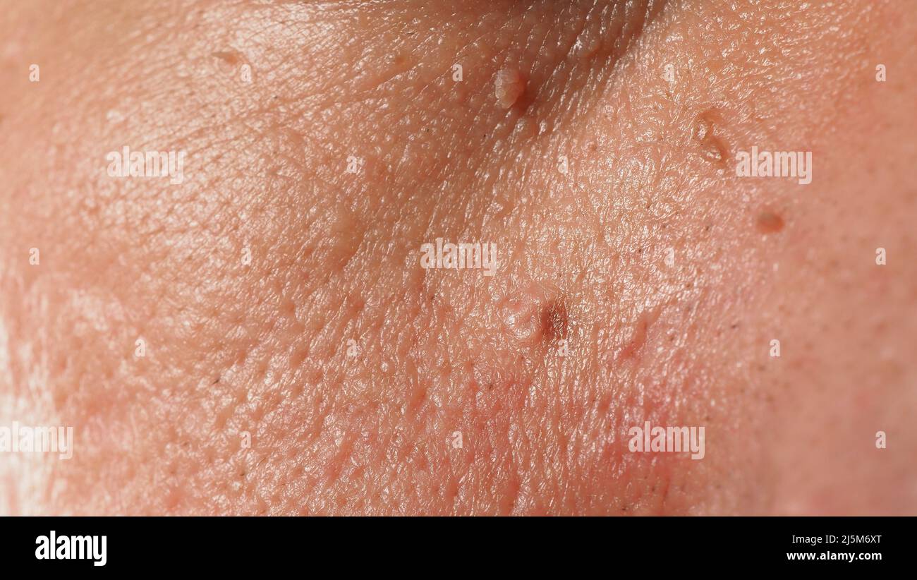 Cancer de la peau mélanome sur le nez Banque de photographies et d ...