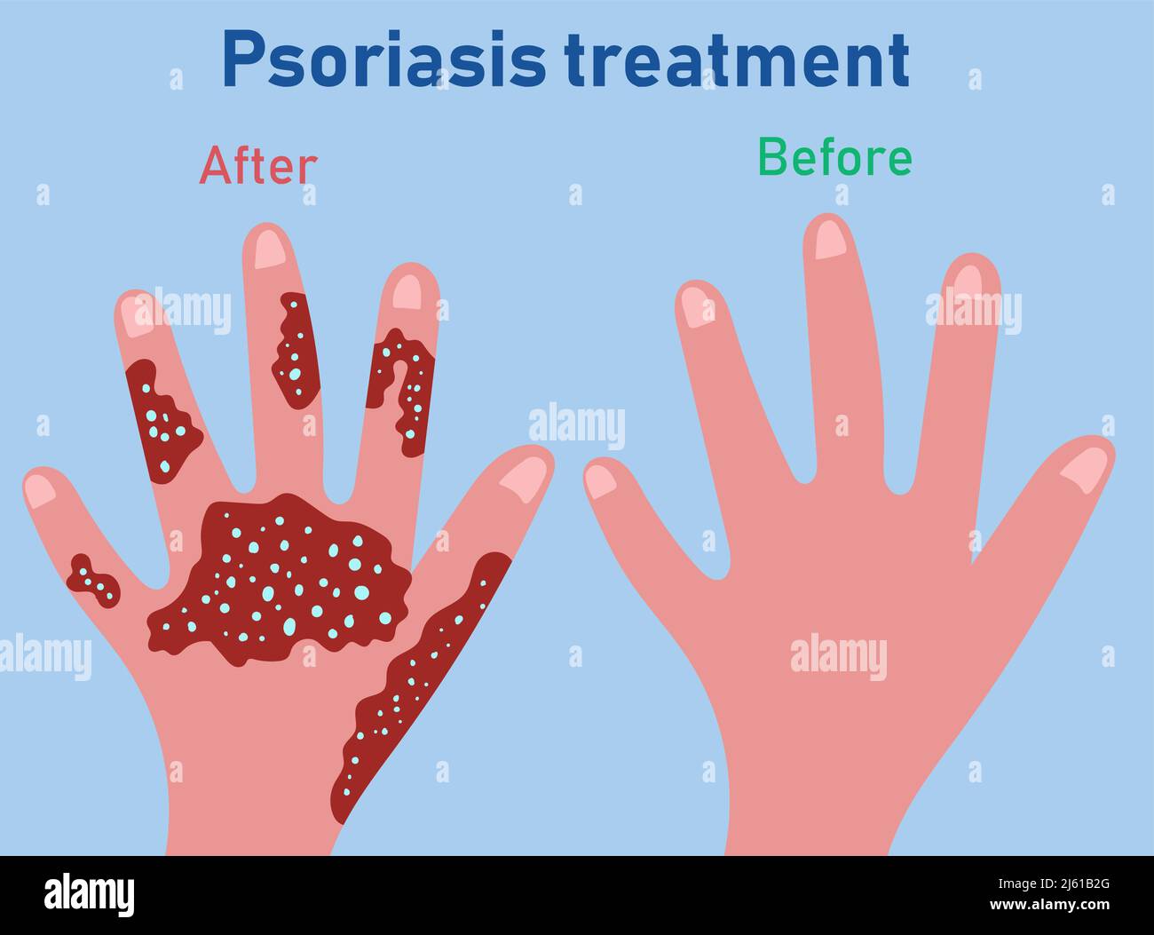 Psoriasis pustuleux Banque de photographies et d’images à haute ...