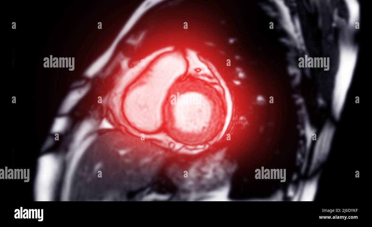 IRM cardiaque ou cardiaque IRM (imagerie par résonance magnétique) du ...