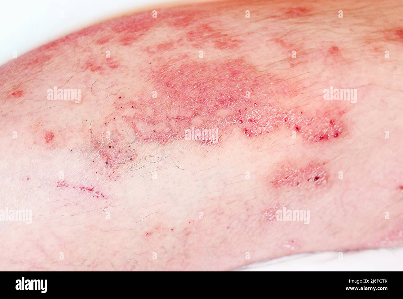Psoriasis aigu, rougissement sévère de la peau, maladie de peau ...