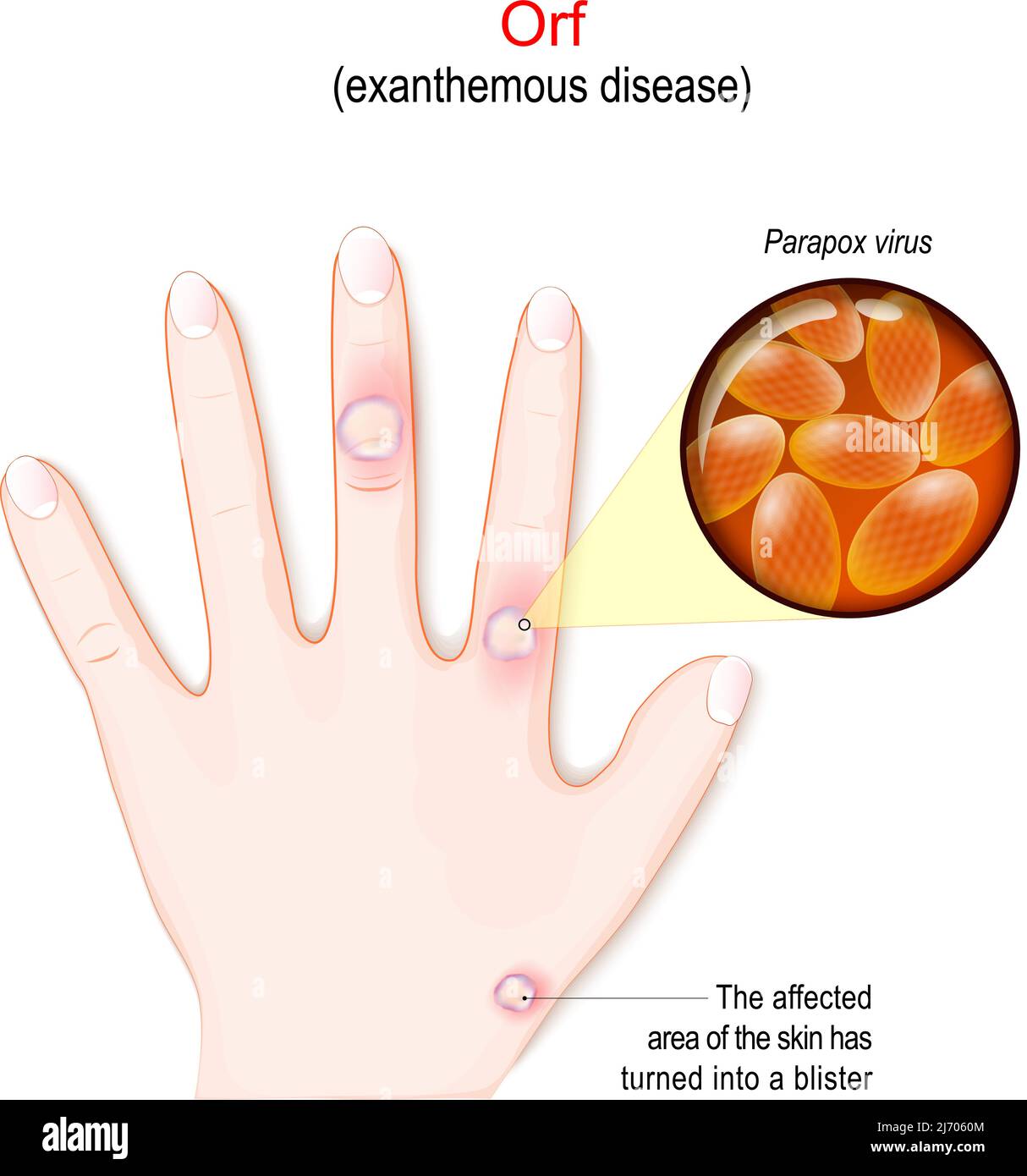 Ou une infection virale de la peau Banque de photographies et d’images ...