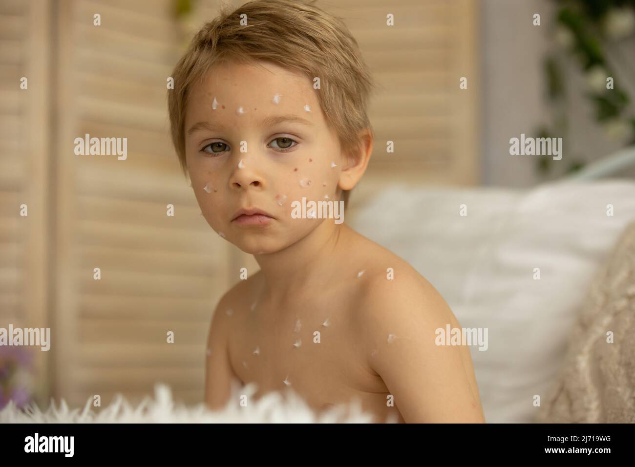 Tout-petit garçon avec la varicelle, couché au lit avec de la fièvre ...