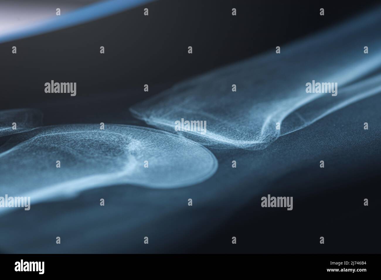 Bursite du genou Banque de photographies et d’images à haute résolution ...