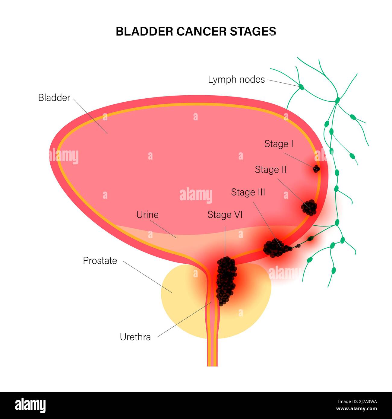 Stades du cancer de la vessie, illustration Photo Stock - Alamy