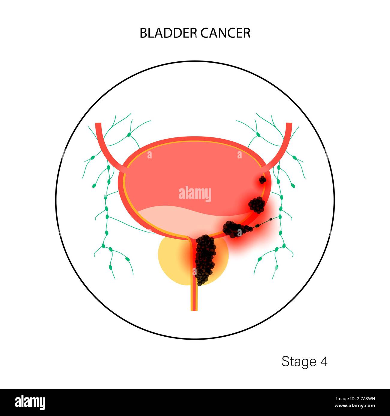 Stades du cancer de la vessie, illustration Photo Stock - Alamy