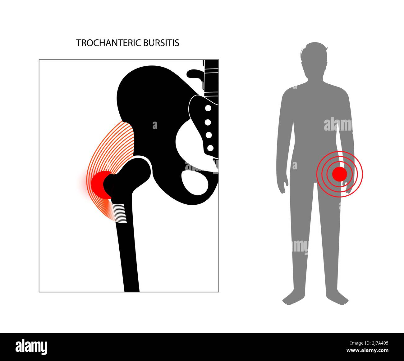 Bursite trochantérienne Banque de photographies et d’images à haute ...