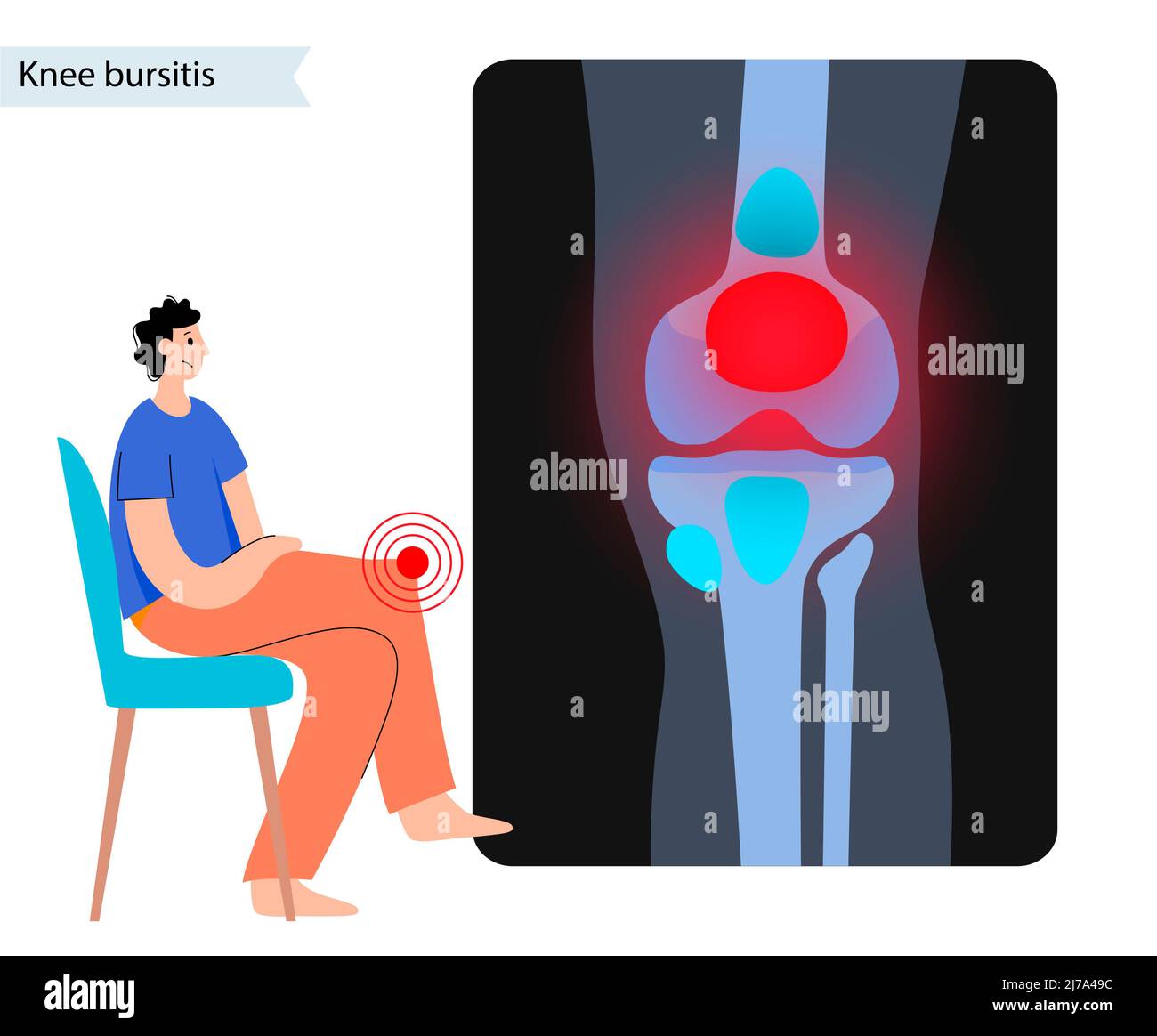 Bursite du genou Banque de photographies et d’images à haute résolution ...