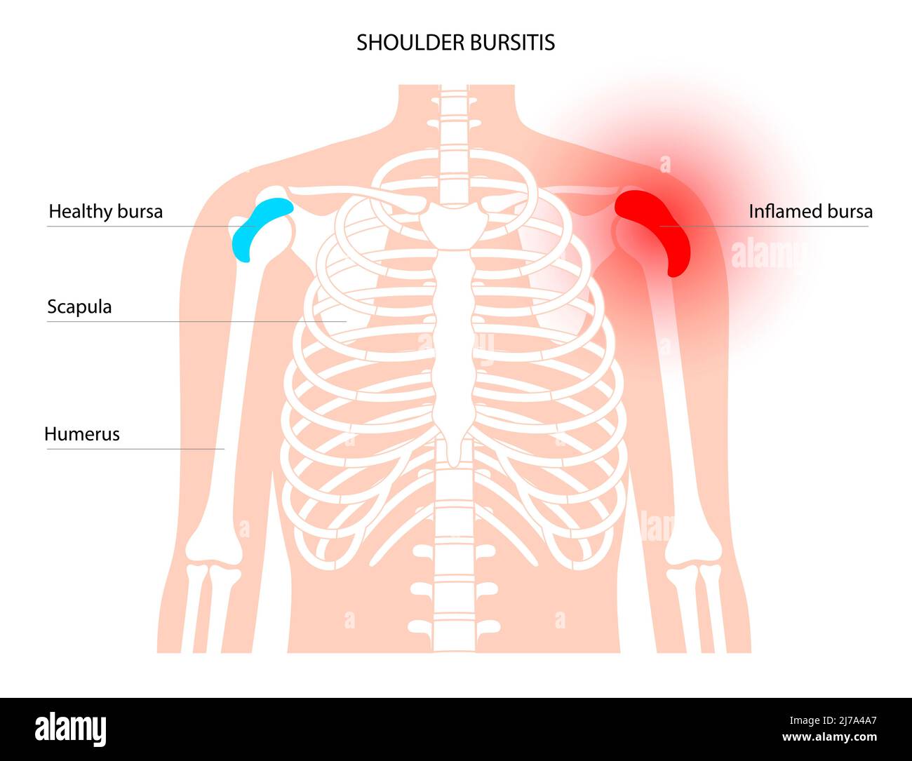 Bursite sous acromiale Banque de photographies et d’images à haute ...