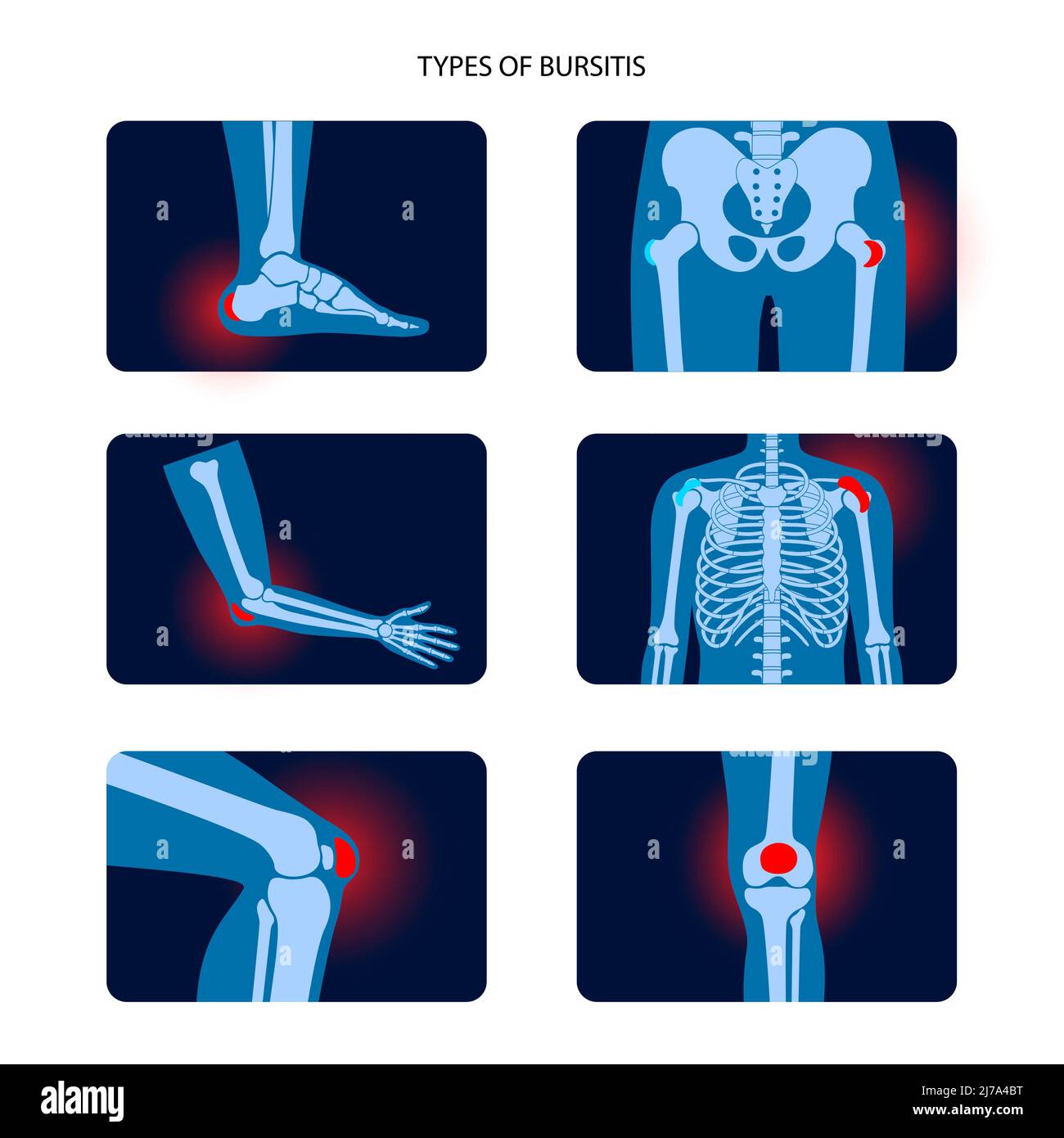 Types de bursite, illustration Photo Stock - Alamy