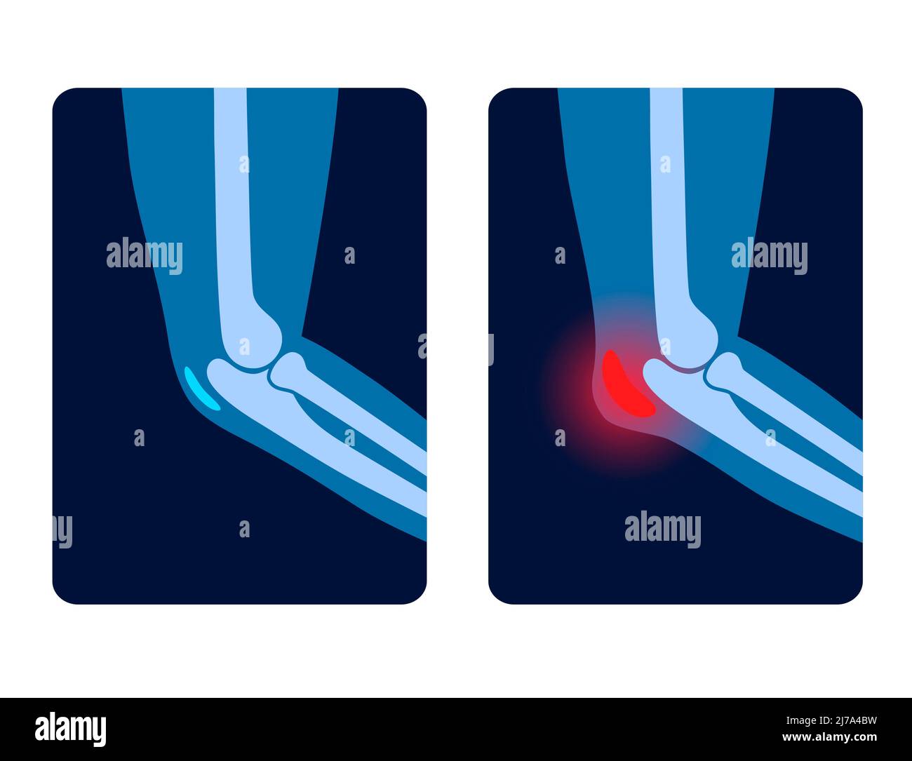 Coude olécranon Banque d'images détourées - Alamy