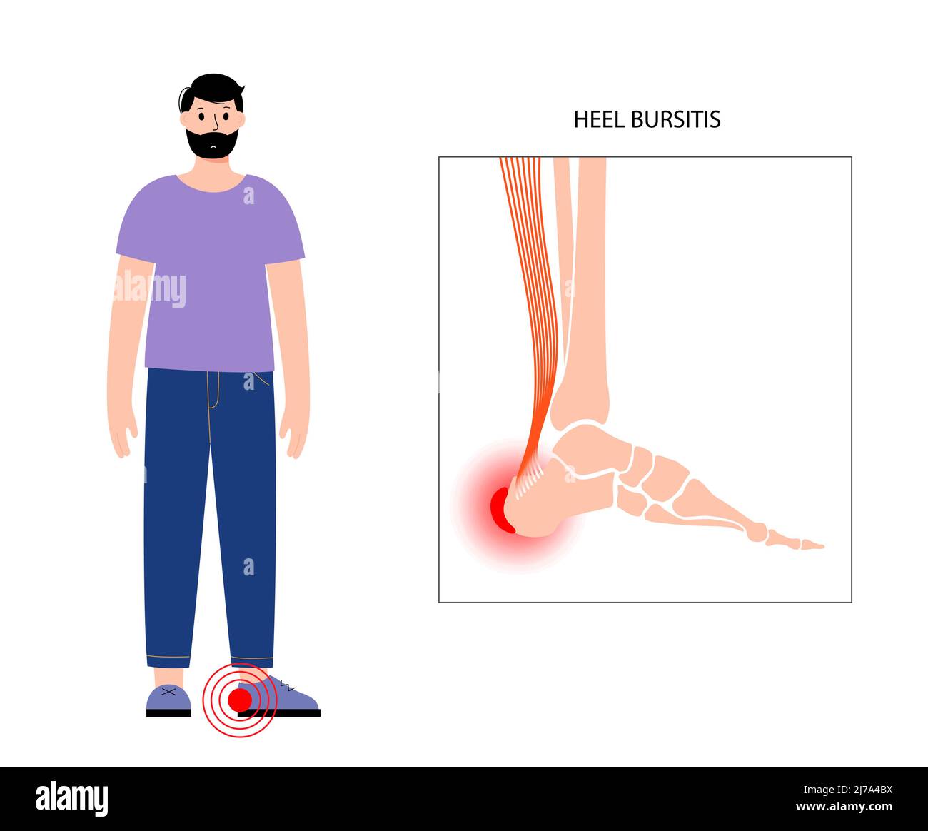 Bursite calcanéenne Banque de photographies et d’images à haute ...