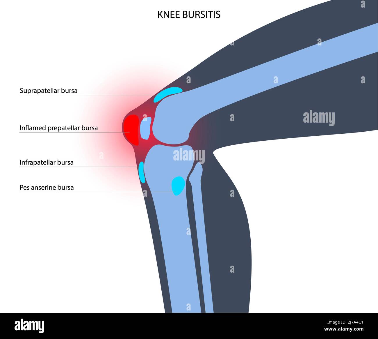 Bursite du genou Banque de photographies et d’images à haute résolution ...