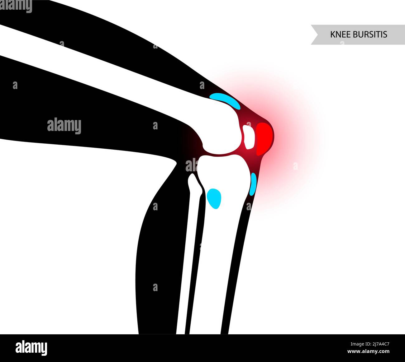 Bourse prépatellaire Banque de photographies et d’images à haute ...
