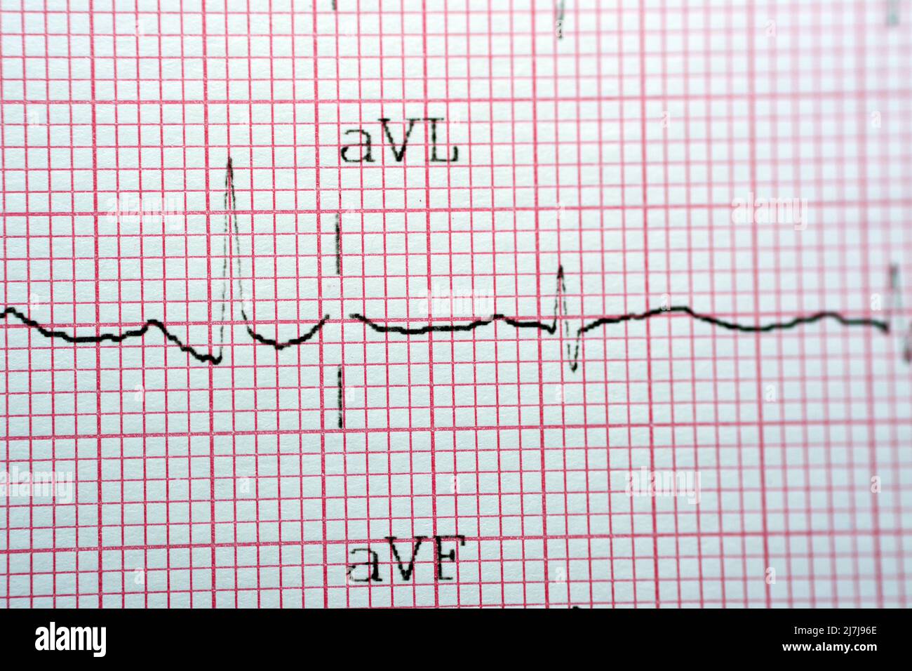 ECG d'électrocardiogramme dans un papier graphique montre le rythme ...