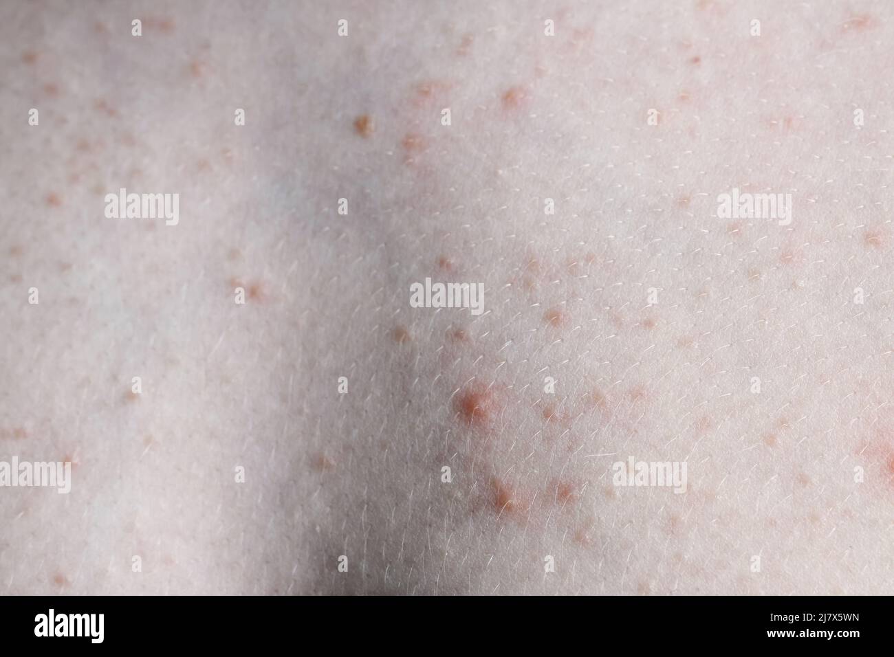 Urticaire chronique Banque de photographies et d’images à haute ...