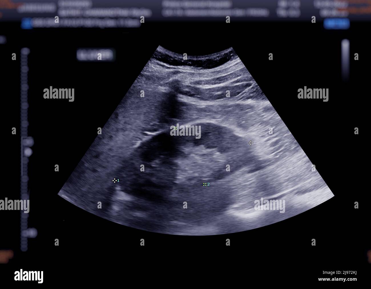 Abdomen Ultrasound Examination Banque De Photographies Et Dimages à