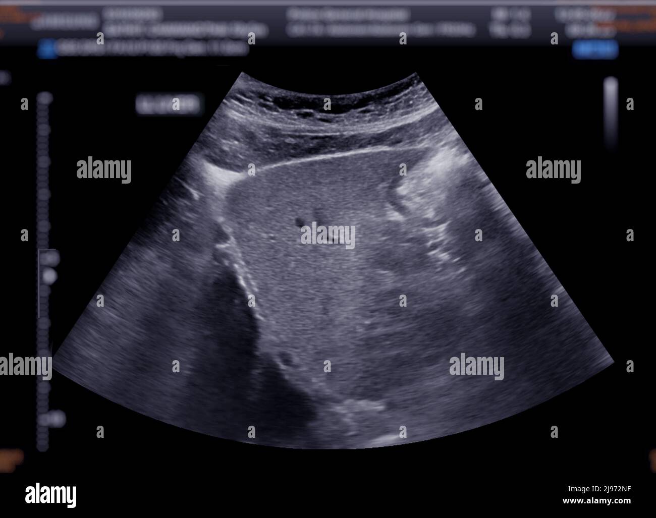 Échographie Du Haut De Labdomen Montrant Le Foie Photo Stock Alamy