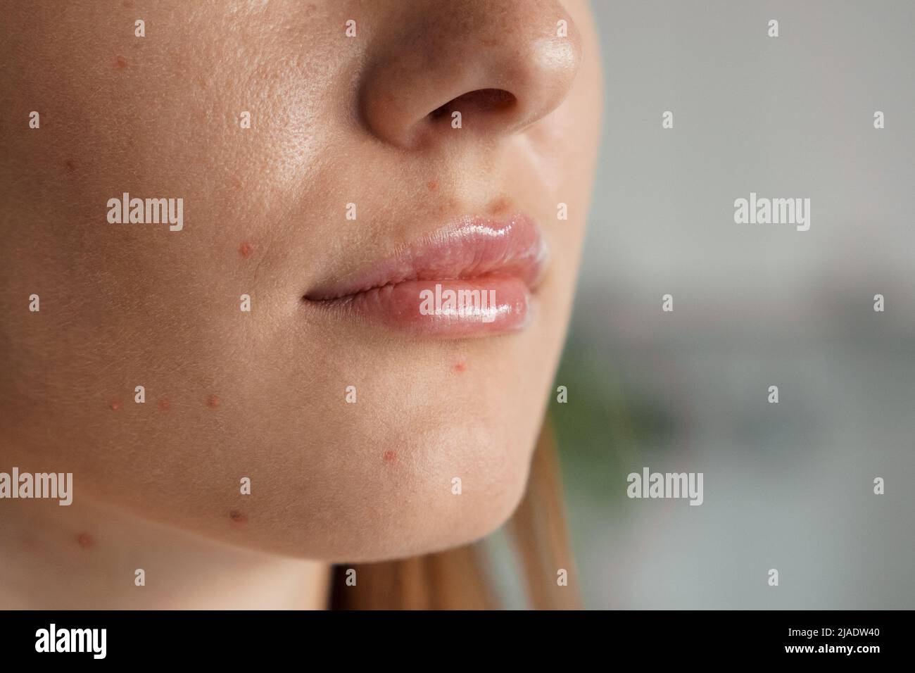 Tache rouge peau Banque de photographies et d’images à haute résolution ...