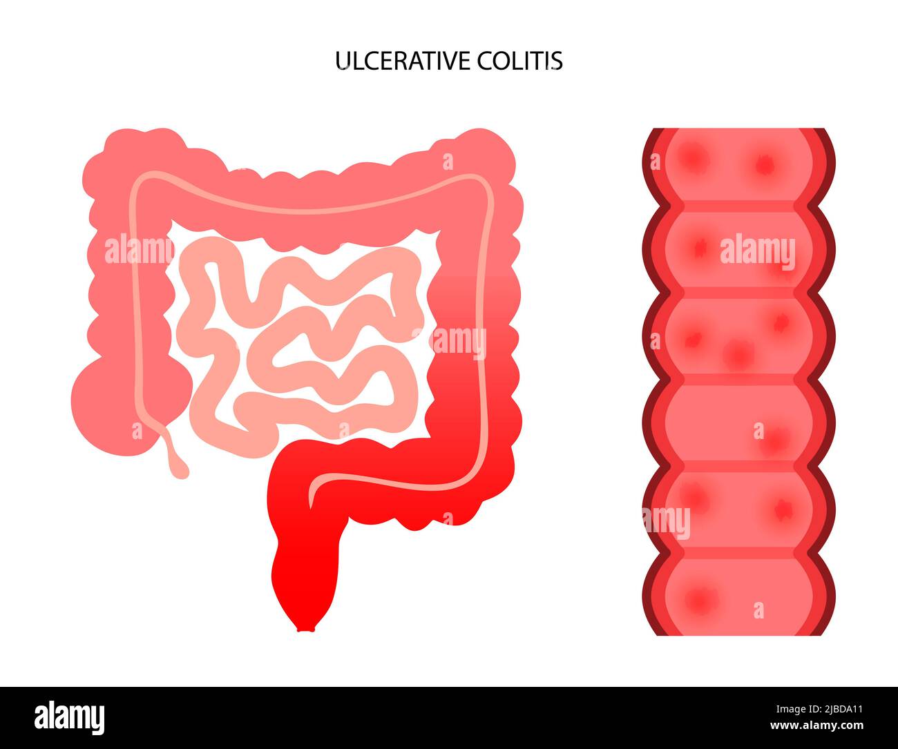 Rectocolite hemorragique Banque d'images détourées - Alamy