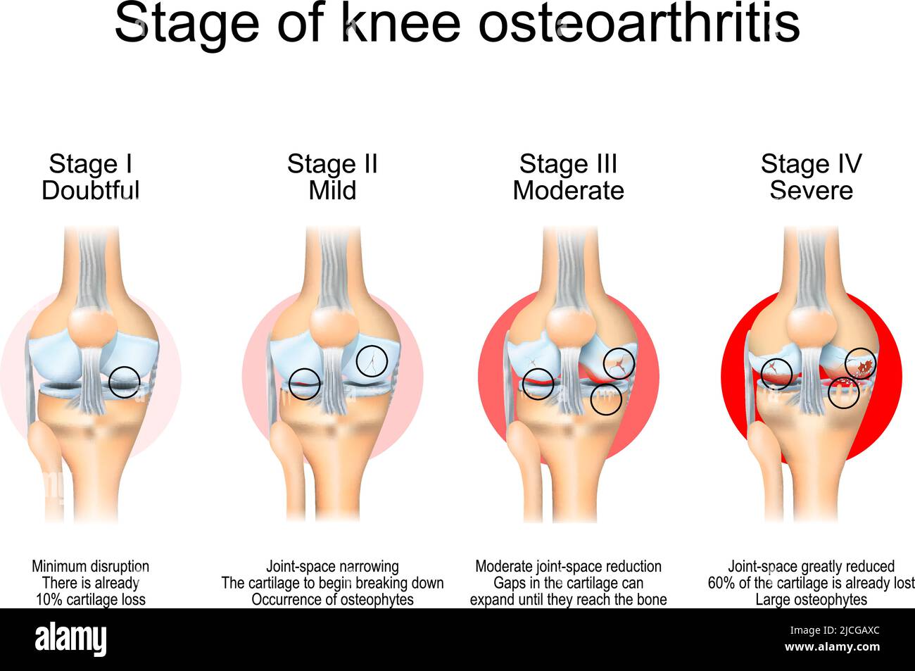Stades de l'arthrose du genou. De la perturbation minimale à la perte d ...