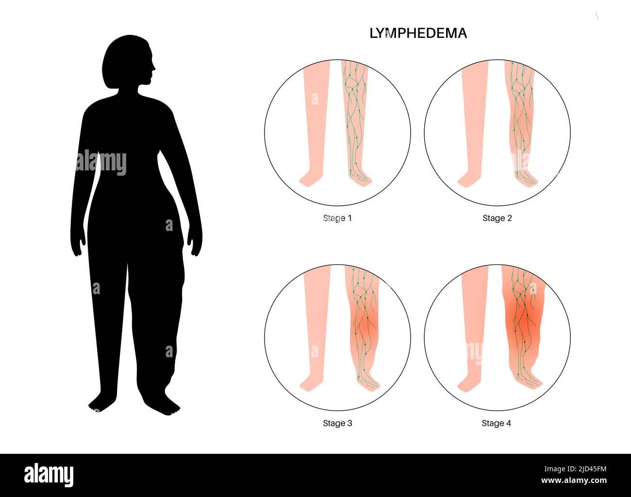 Douleur système lymphatique système immunitaire anatomie drainage ...