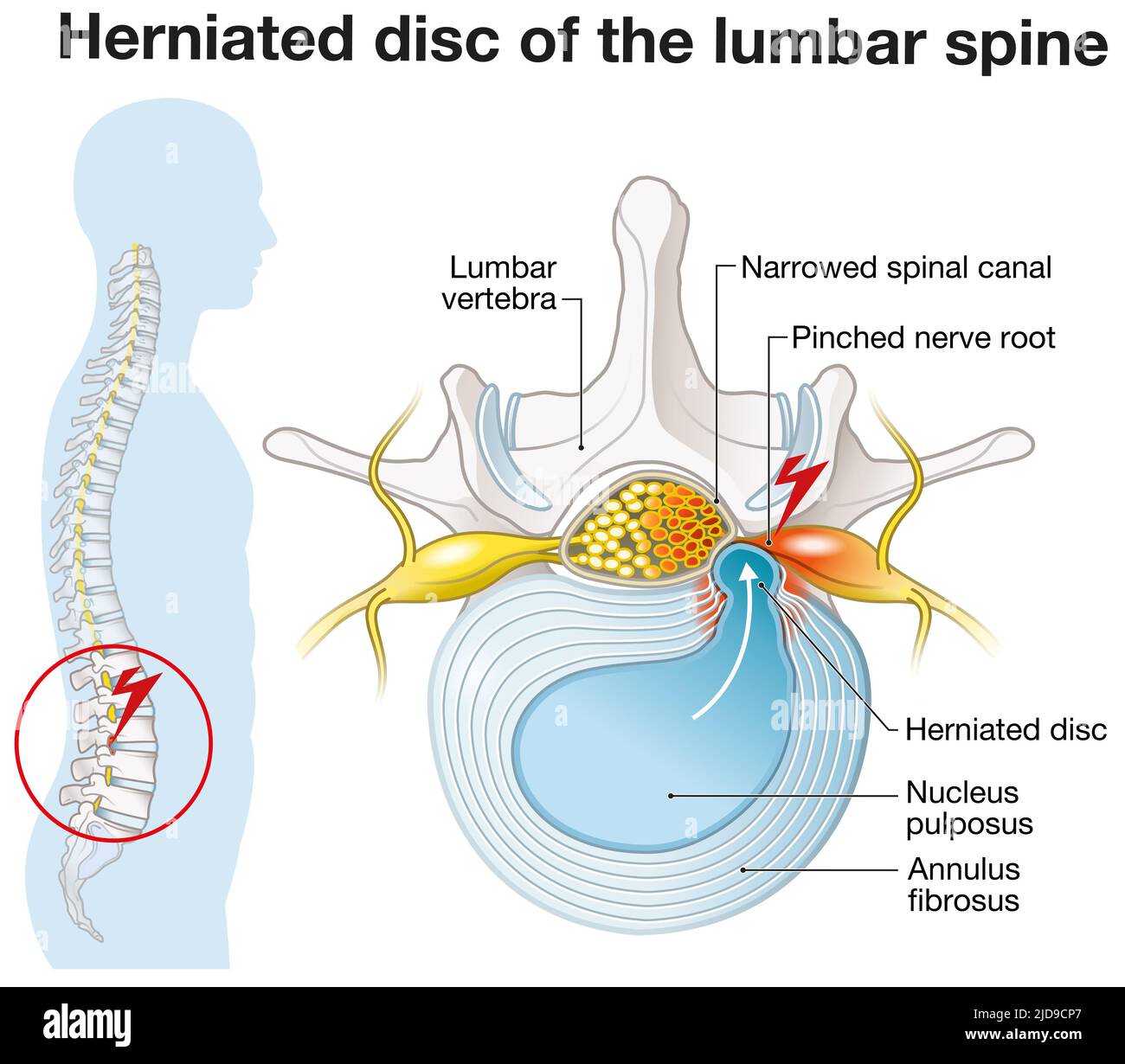 Illustration montrant la vertèbre lombaire avec disque intervertébral ...