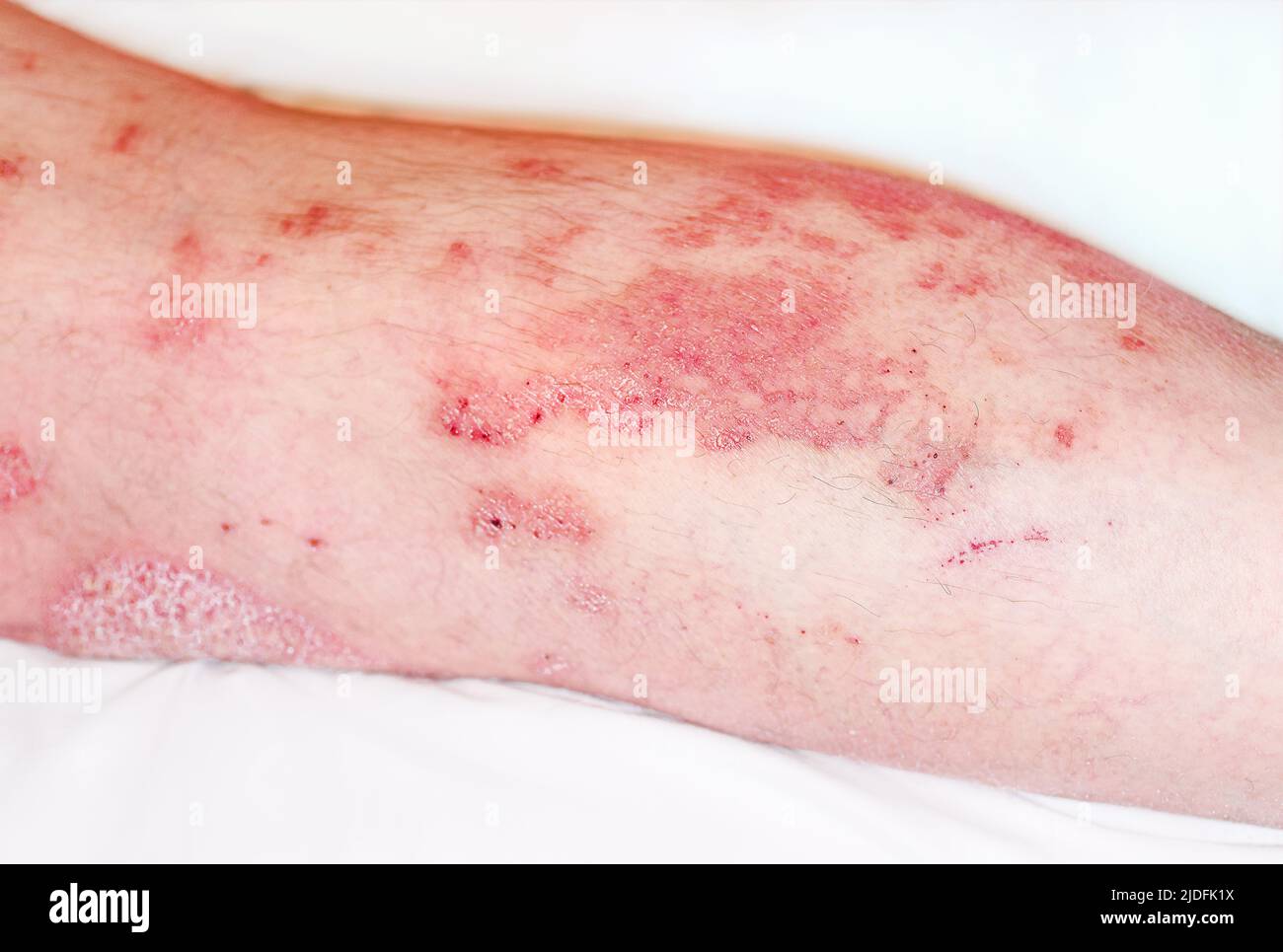 Grande éruption rouge, enflammée, squameuse sur les jambes de l'homme ...