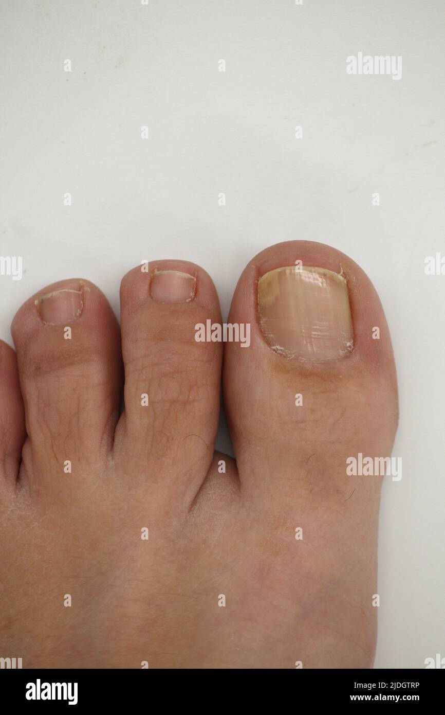 Fungal nail infection feet Banque de photographies et d’images à haute ...