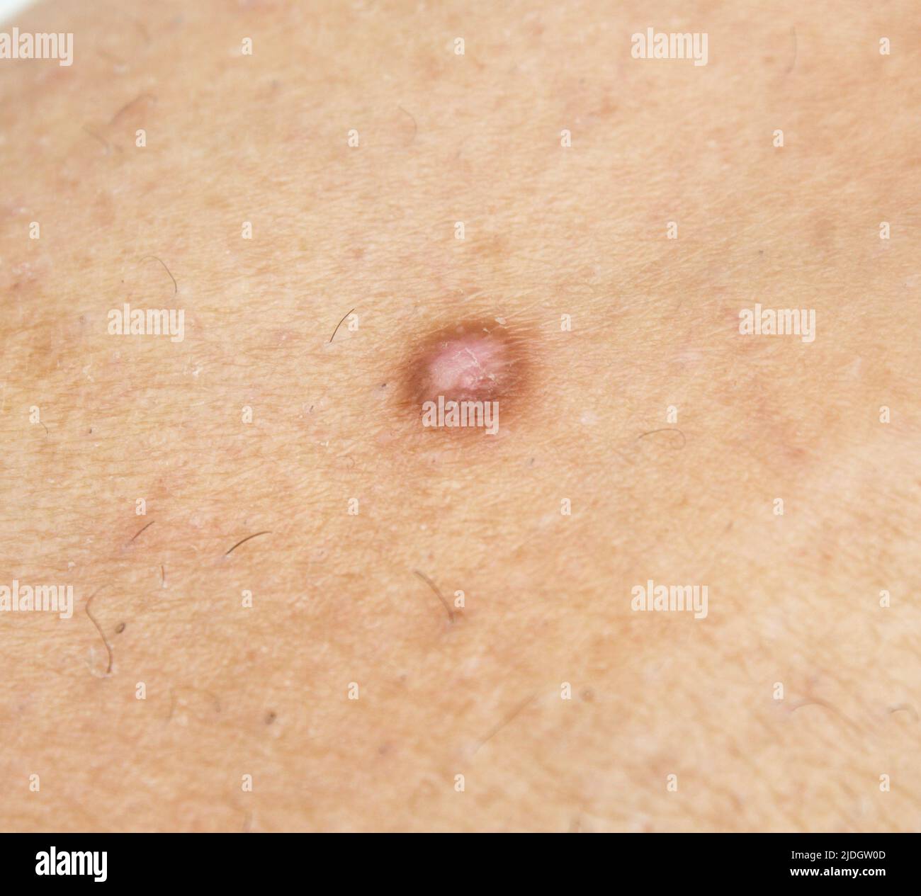 Cicatrice sur la peau Banque de photographies et d’images à haute ...