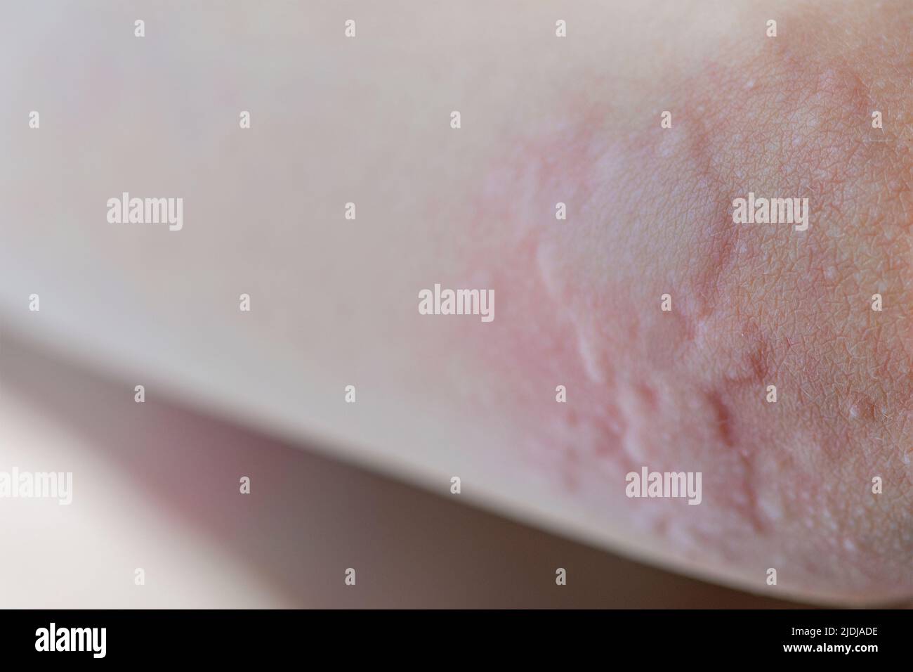 Urticaire sur la peau. Taches rouges d'une réaction allergique sur la ...