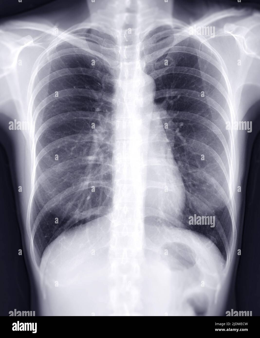 Radiographie thoracique pour le dépistage de la tuberculose, de la ...