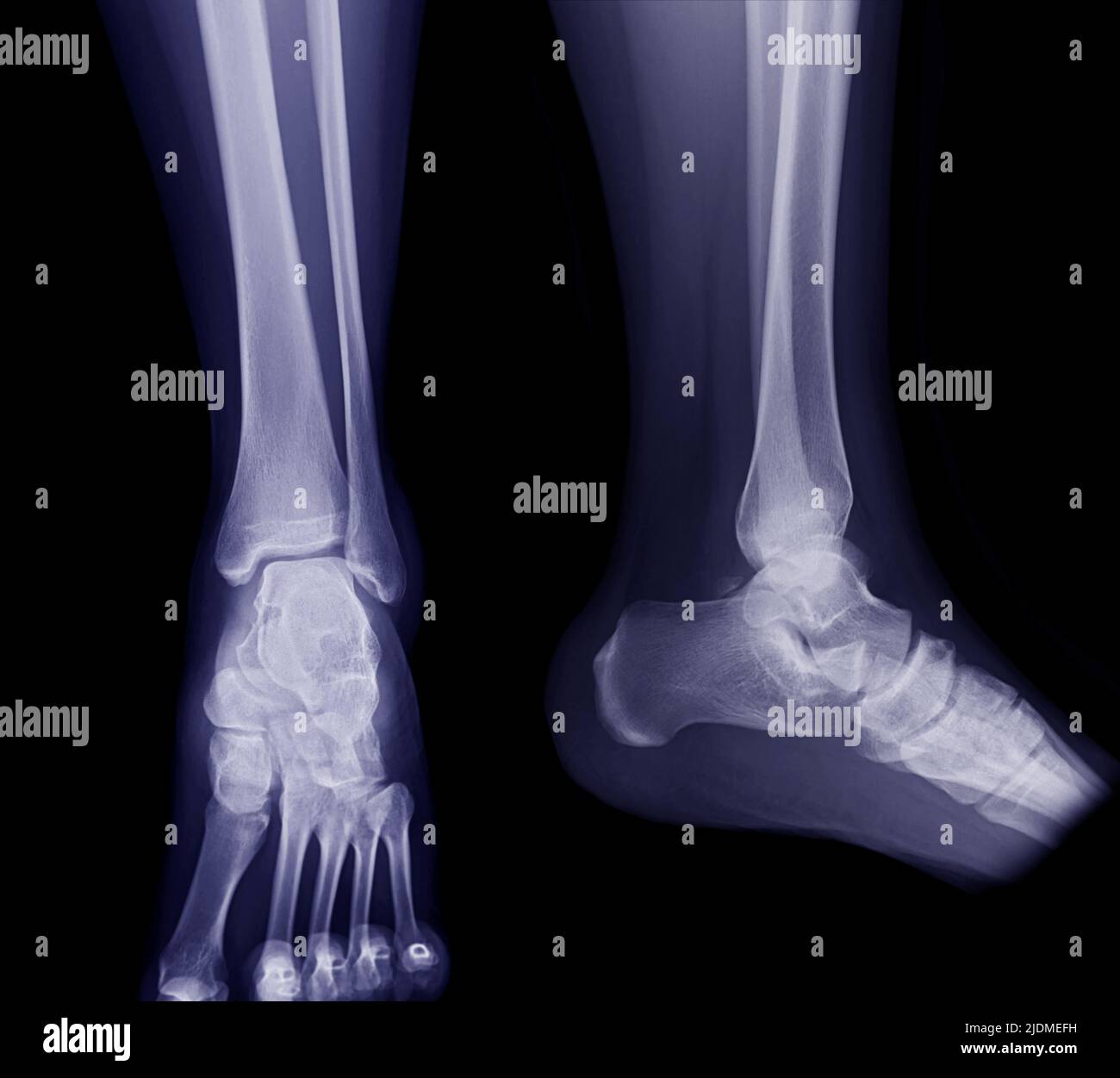 Image radiographique de l'articulation de la cheville vue AP et ...
