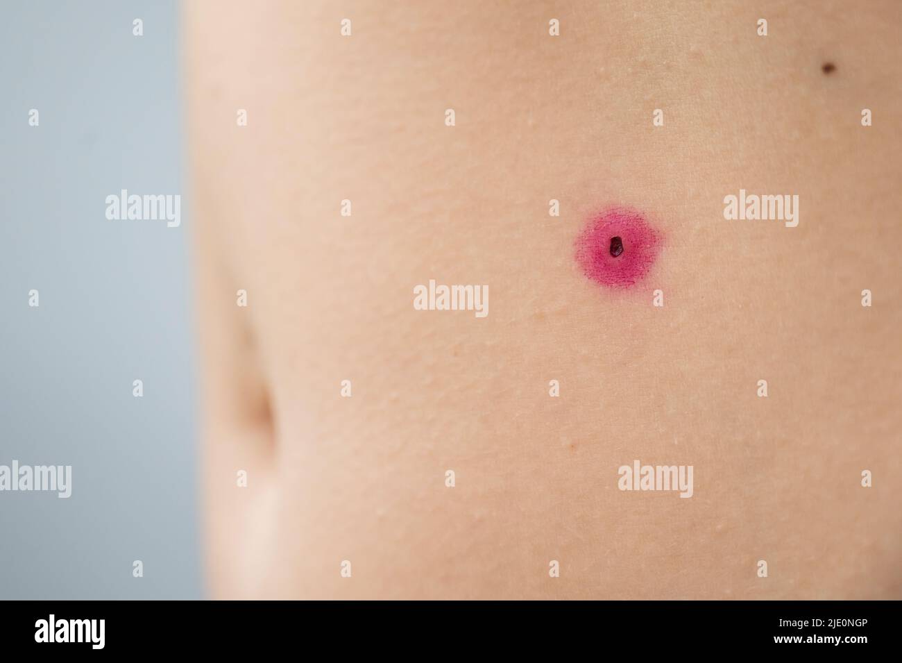 Gros plan d'une verrue enlevée sur l'abdomen d'une femme ...