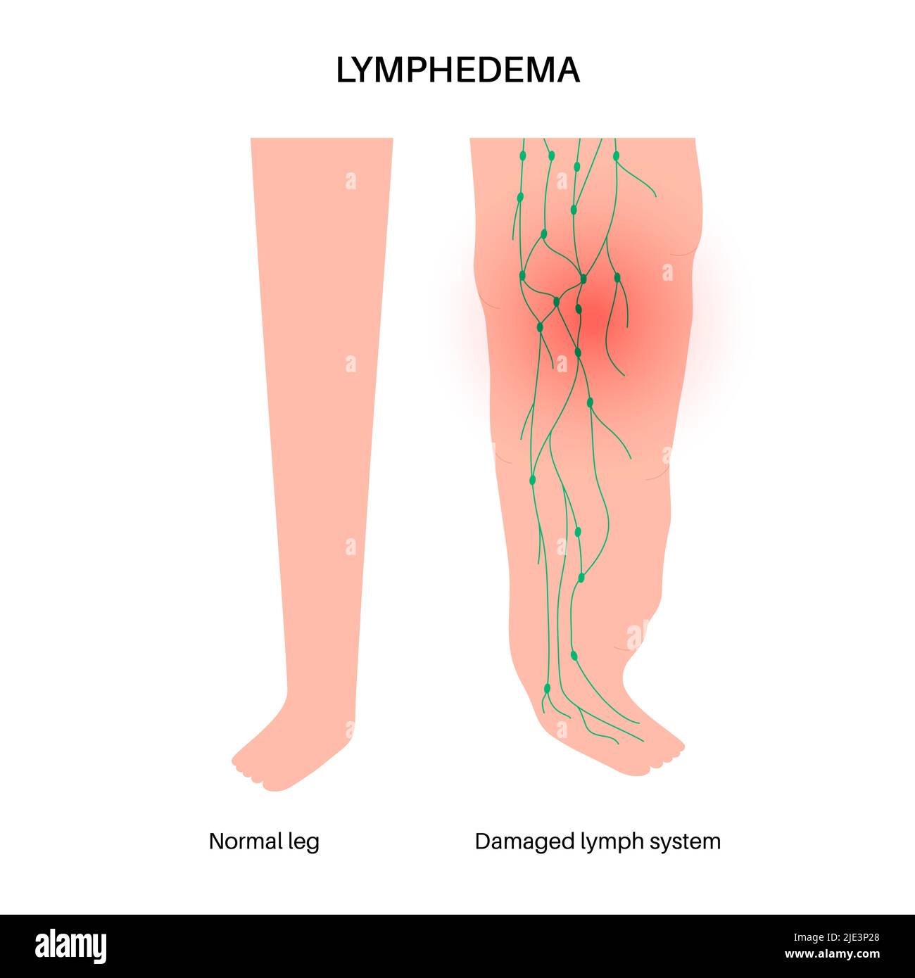 Douleur système lymphatique système immunitaire anatomie drainage ...