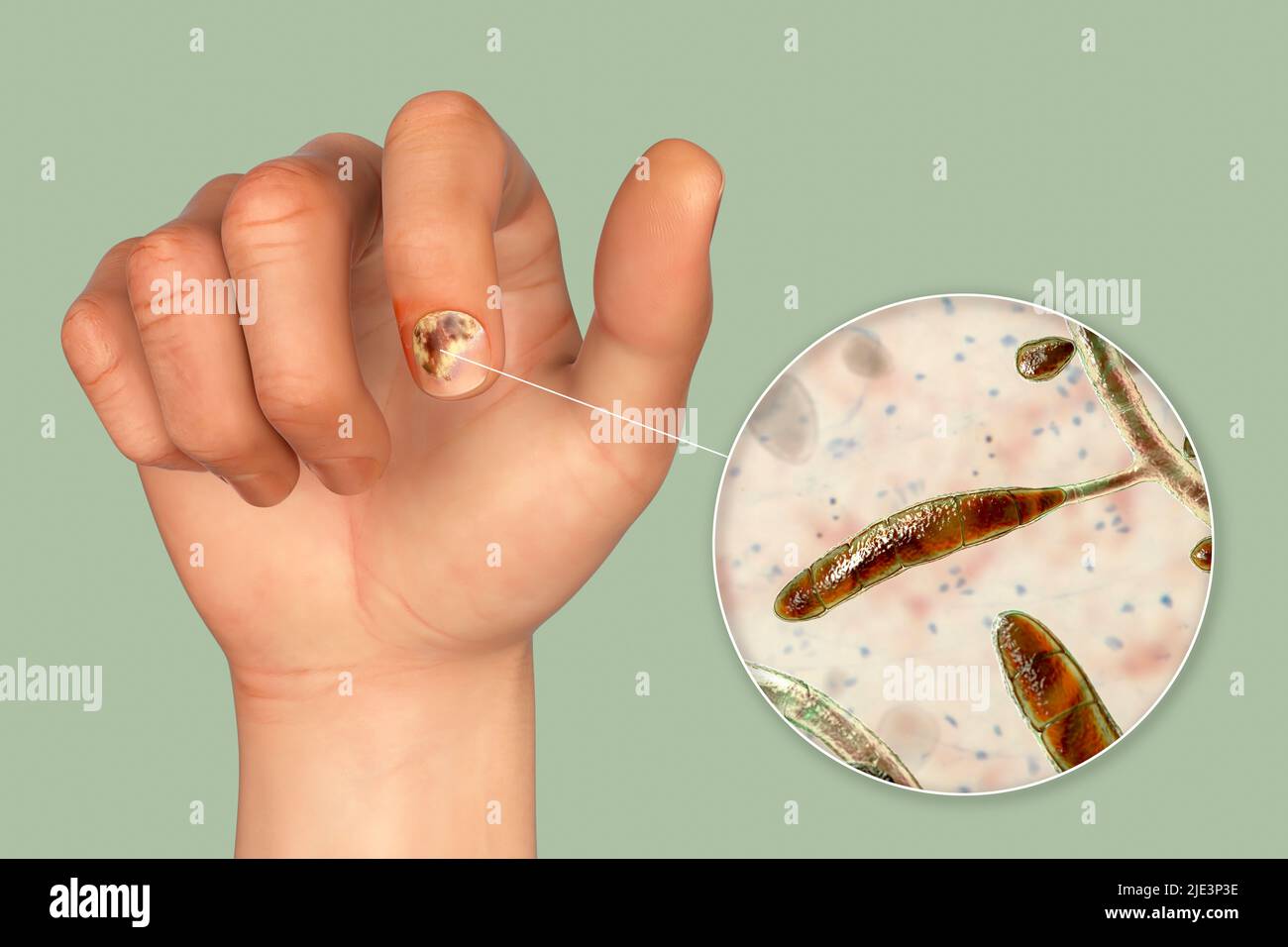 Illustration d'une infection fongique des ongles montrant la main ...