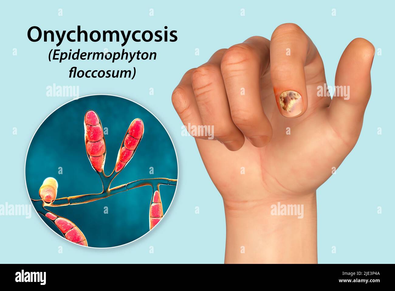 Illustration d'une infection fongique des ongles montrant la main ...