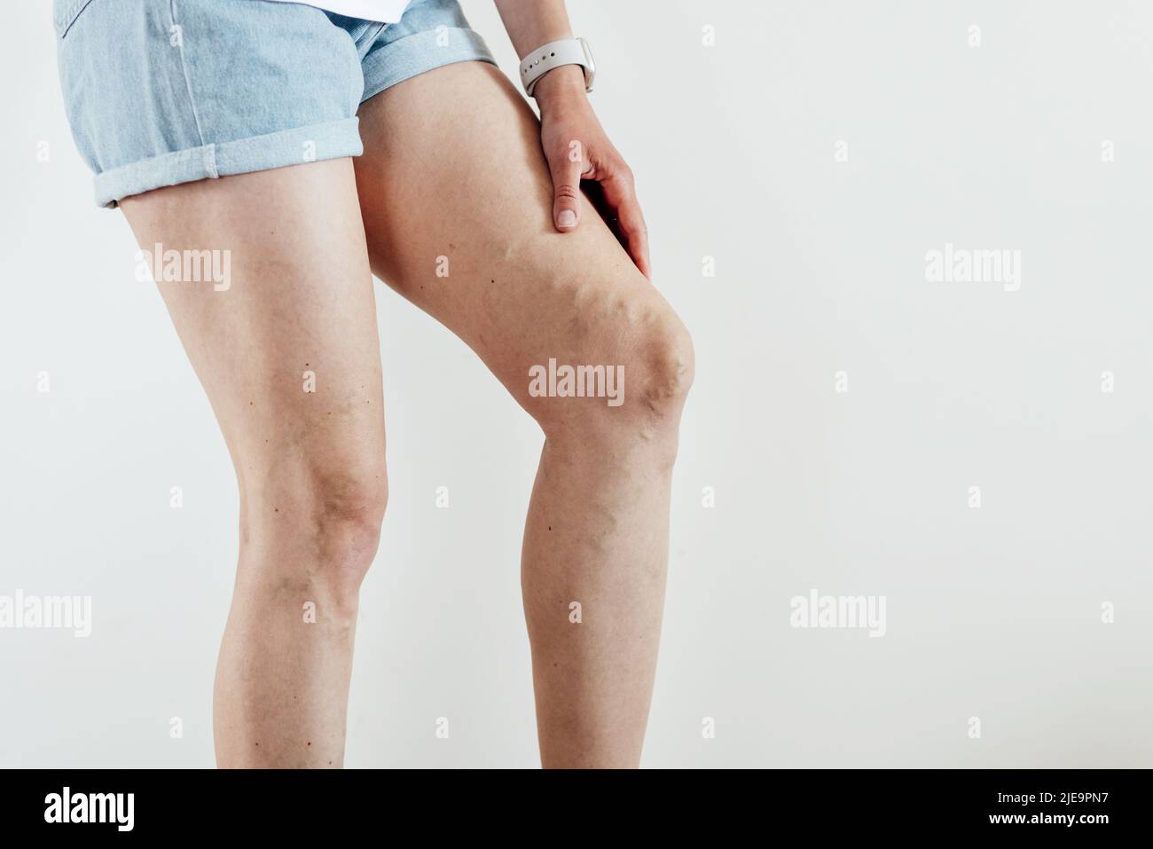 Thrombose veineuse superficielle Banque de photographies et d’images à ...