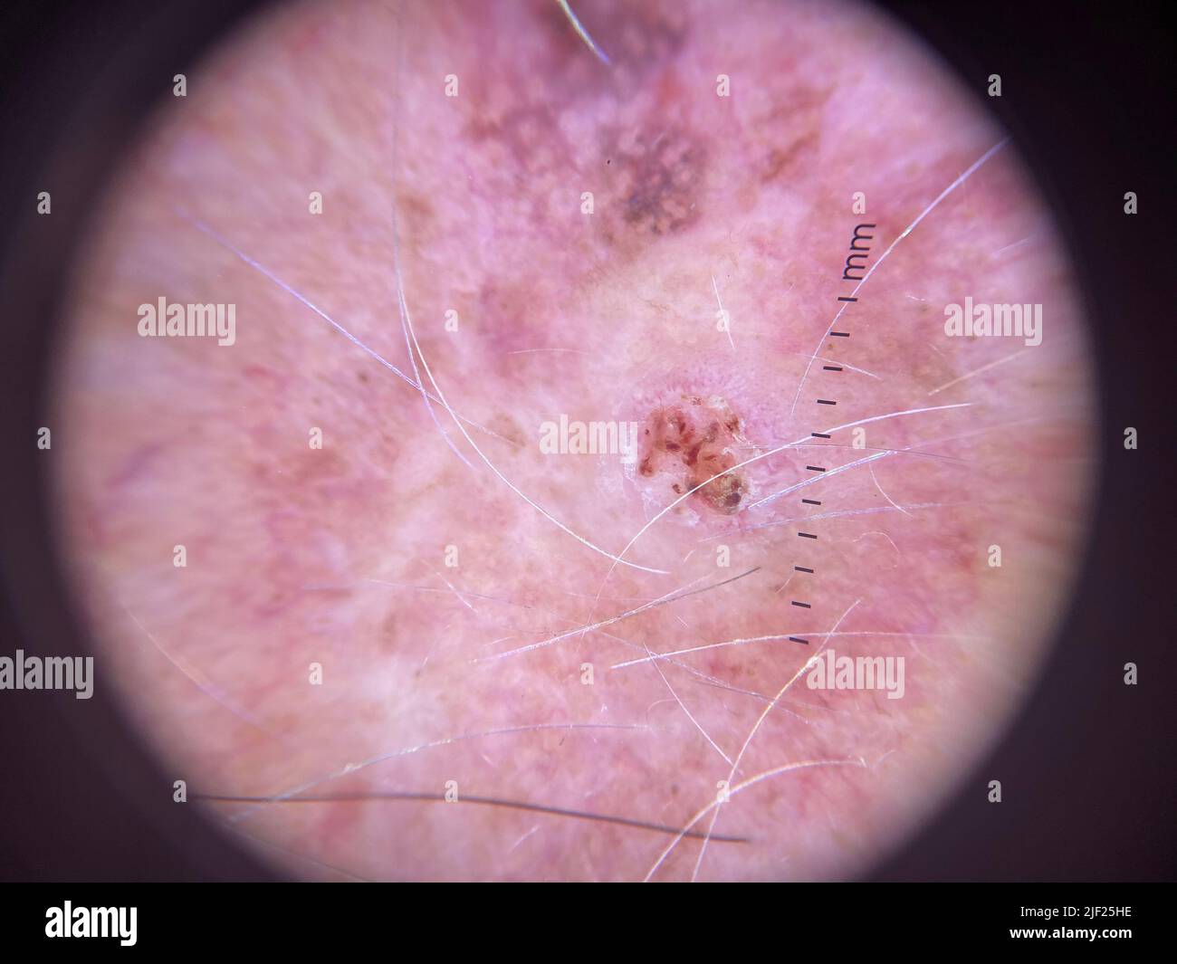 Image du Dermatoscope d'un kératoacanthome avec des vaisseaux sanguins ...