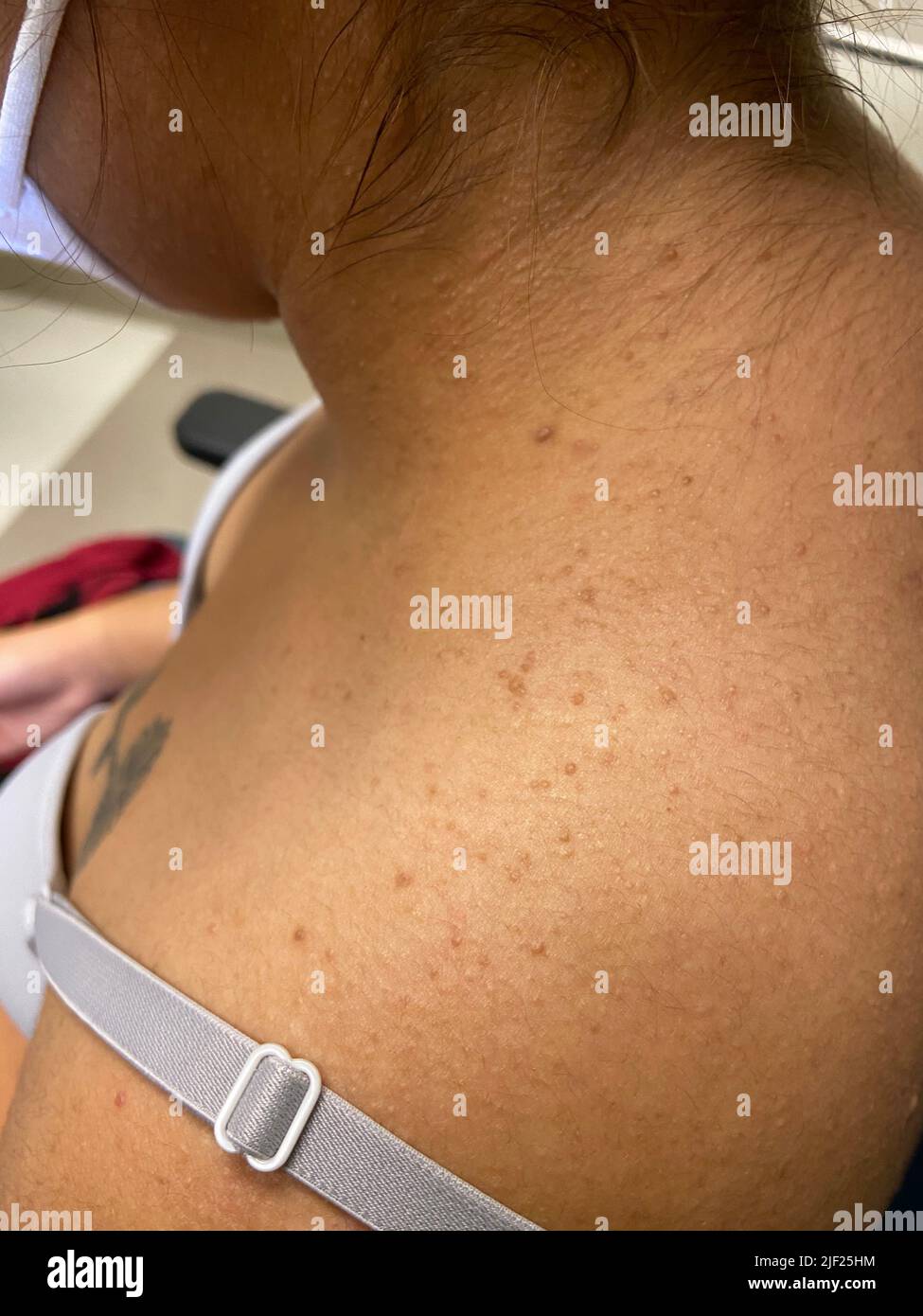 Folliculite de Malassezia chez une patiente hispanique de 25 ans. Il s ...