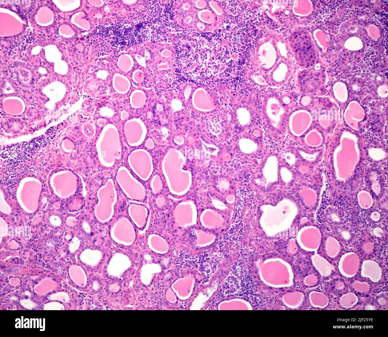 Micrographe léger d'une thyroïde humaine avec thyroïdite chronique ...