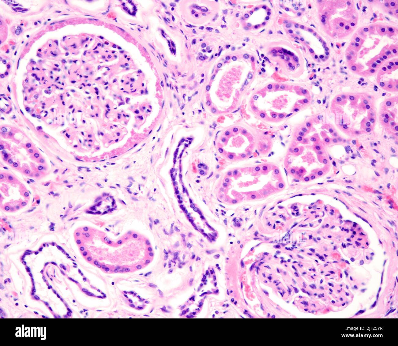 Micrographe léger d'un rein humain affecté par une néphropathie ...