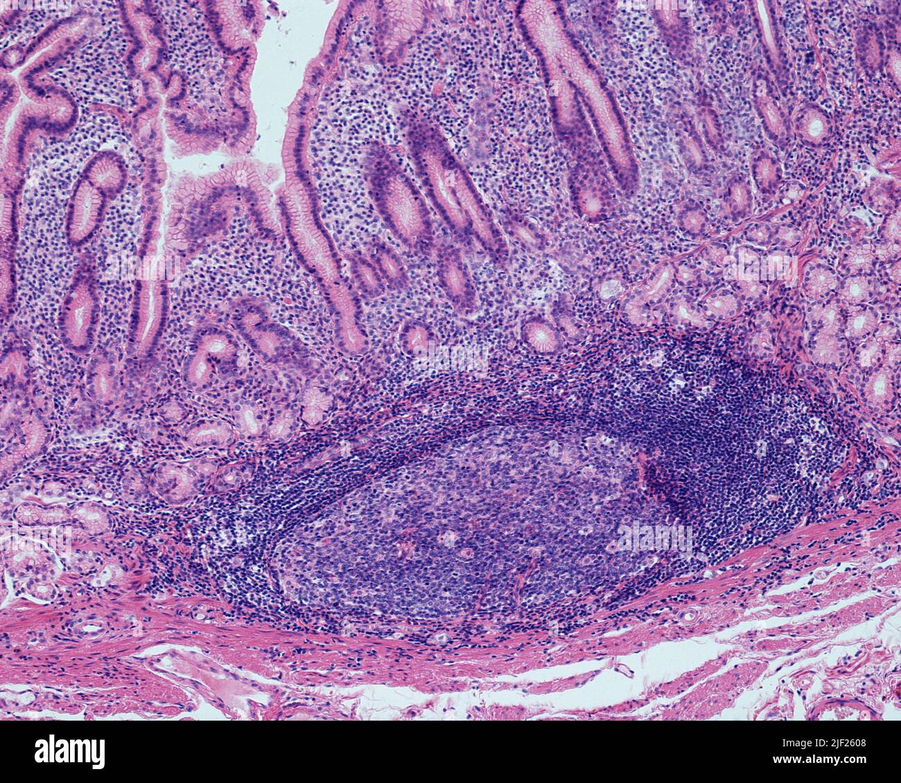Gastrite chronique. Micrographe léger de la muqueuse gastrique antrale ...
